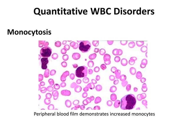 Benign White blood cell (WBC) Disorders | PPTX