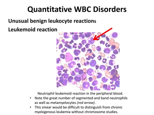 Benign White blood cell (WBC) Disorders | PPTX