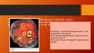 White dot syndrome | PPTX