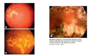 White dot syndromes | PPTX