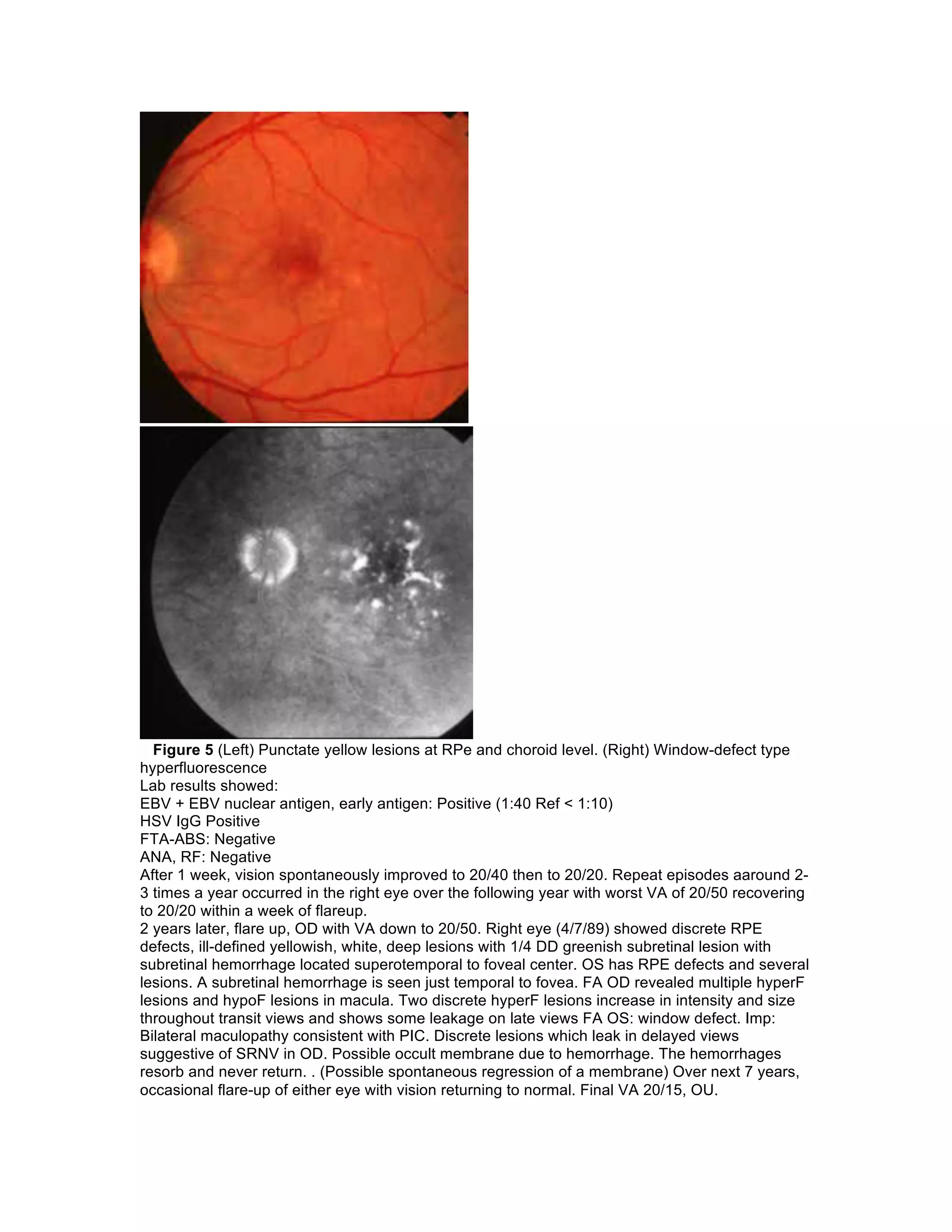 white_dot_syndromes.pdf