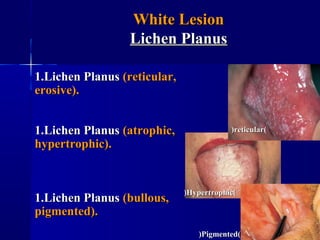 White lesions | PPT
