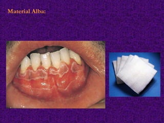 Oral White Lesions | PPT