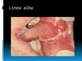 White lesions | PPTX