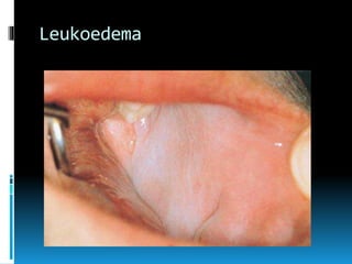 White lesions | PPTX