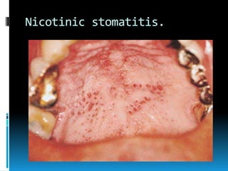 White lesions | PPTX
