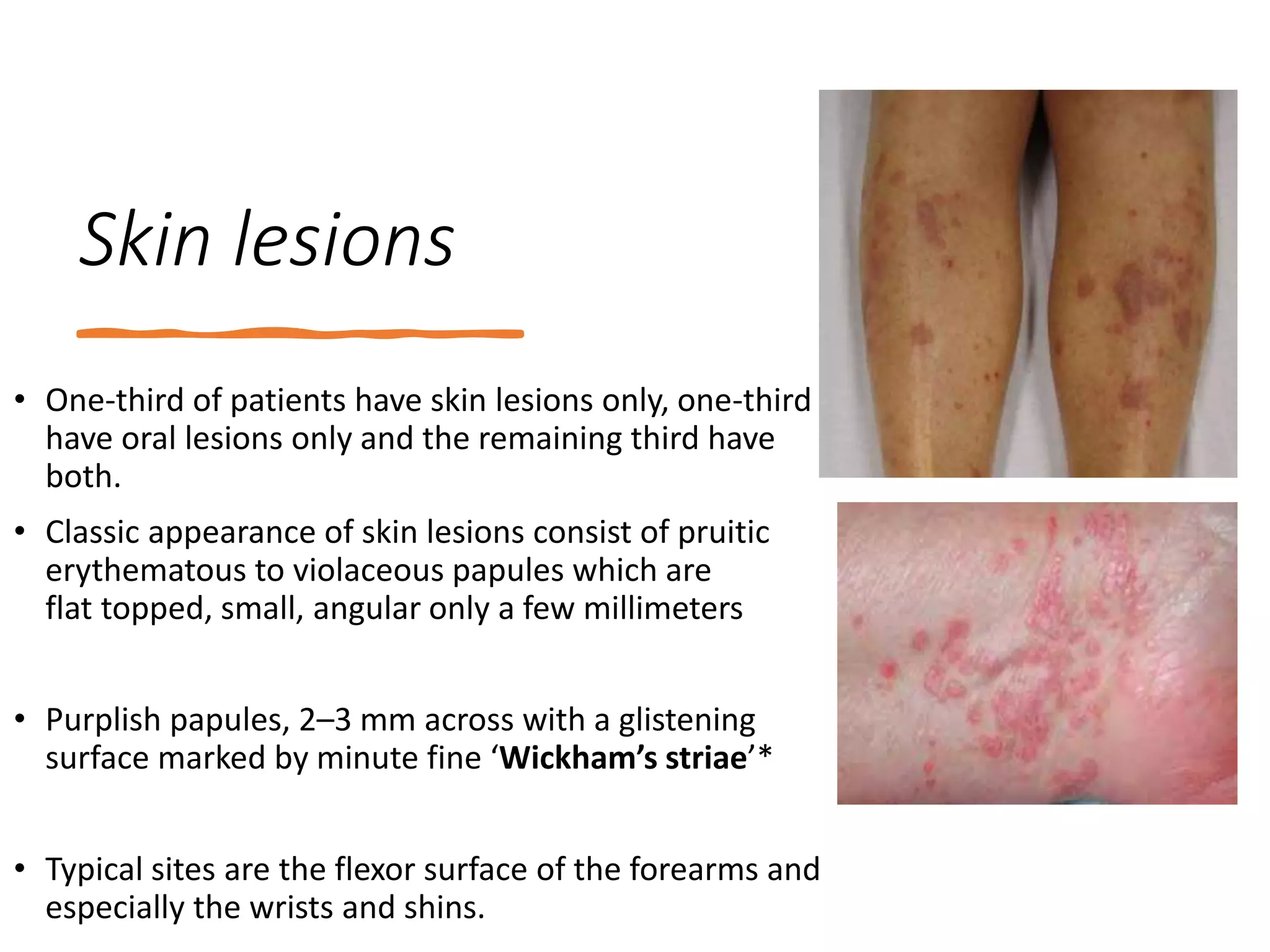 white lesions.pptx