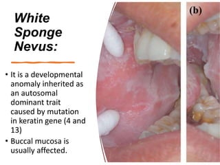 white lesions.pptx