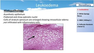 Leukoedema