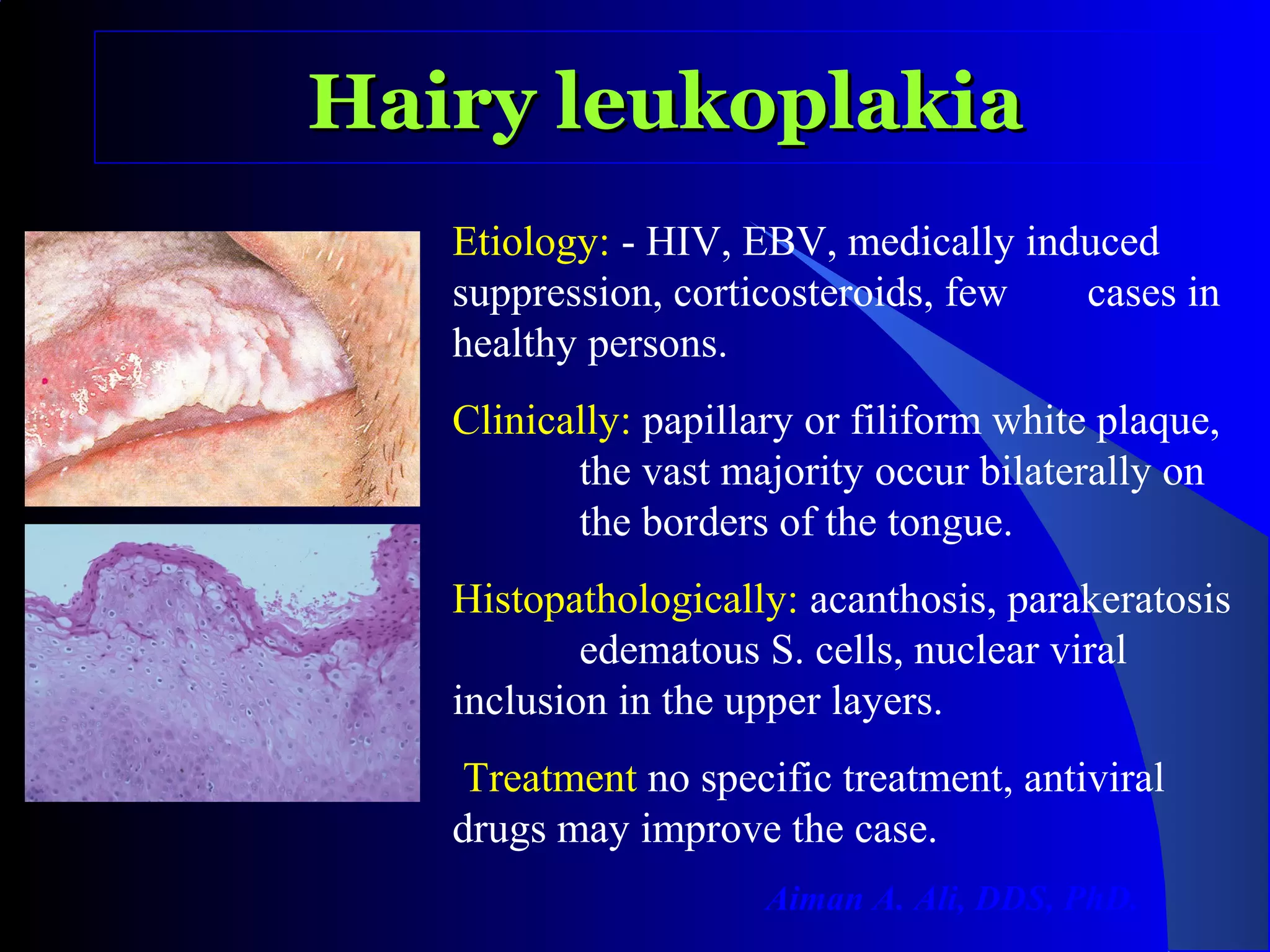 Oral White lesions | PPT