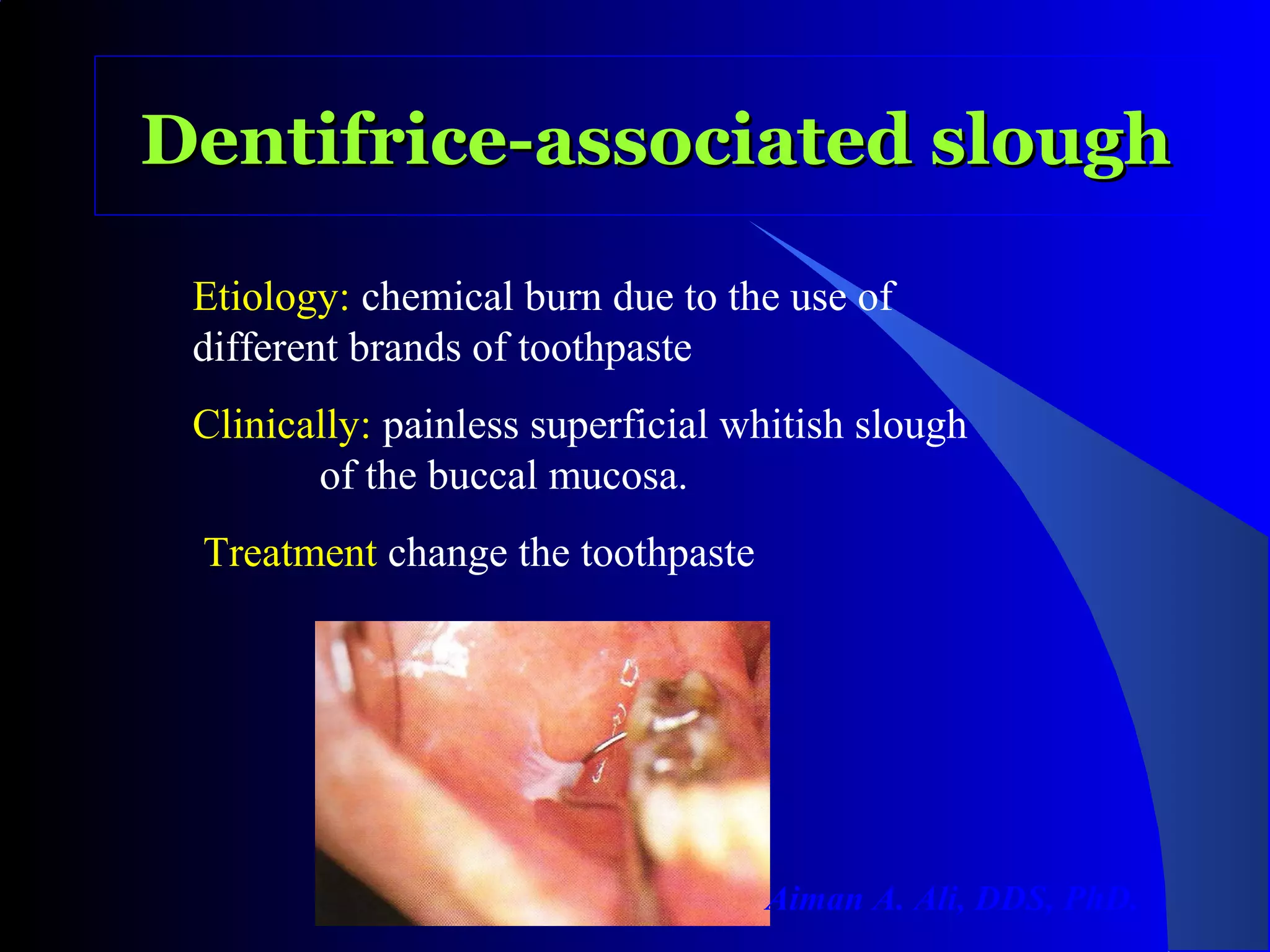 Oral White lesions | PPT