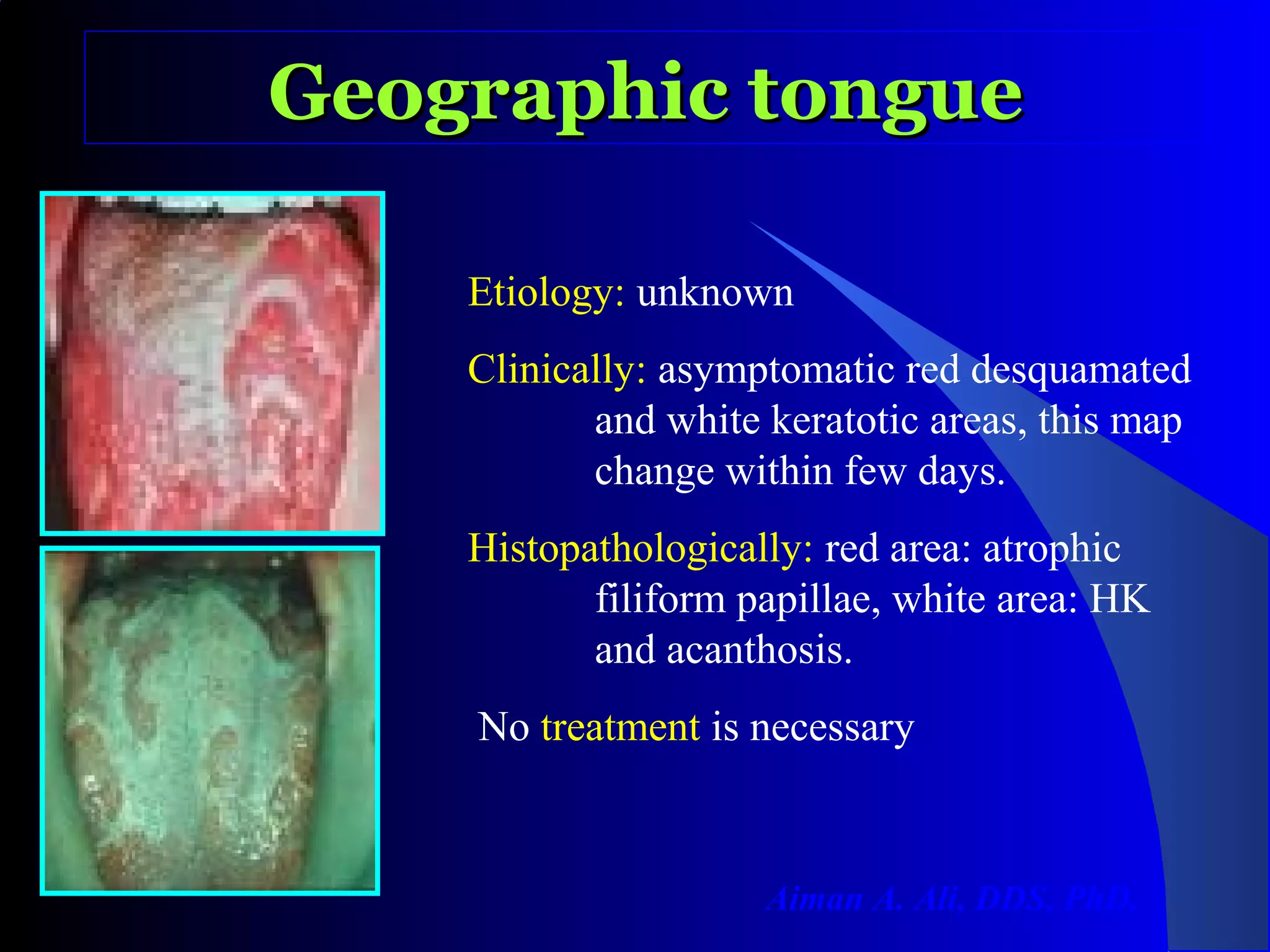 Oral White lesions | PPT