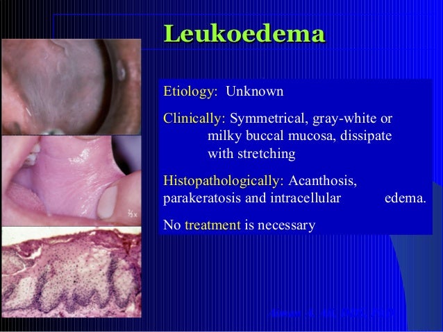 Oral White lesions
