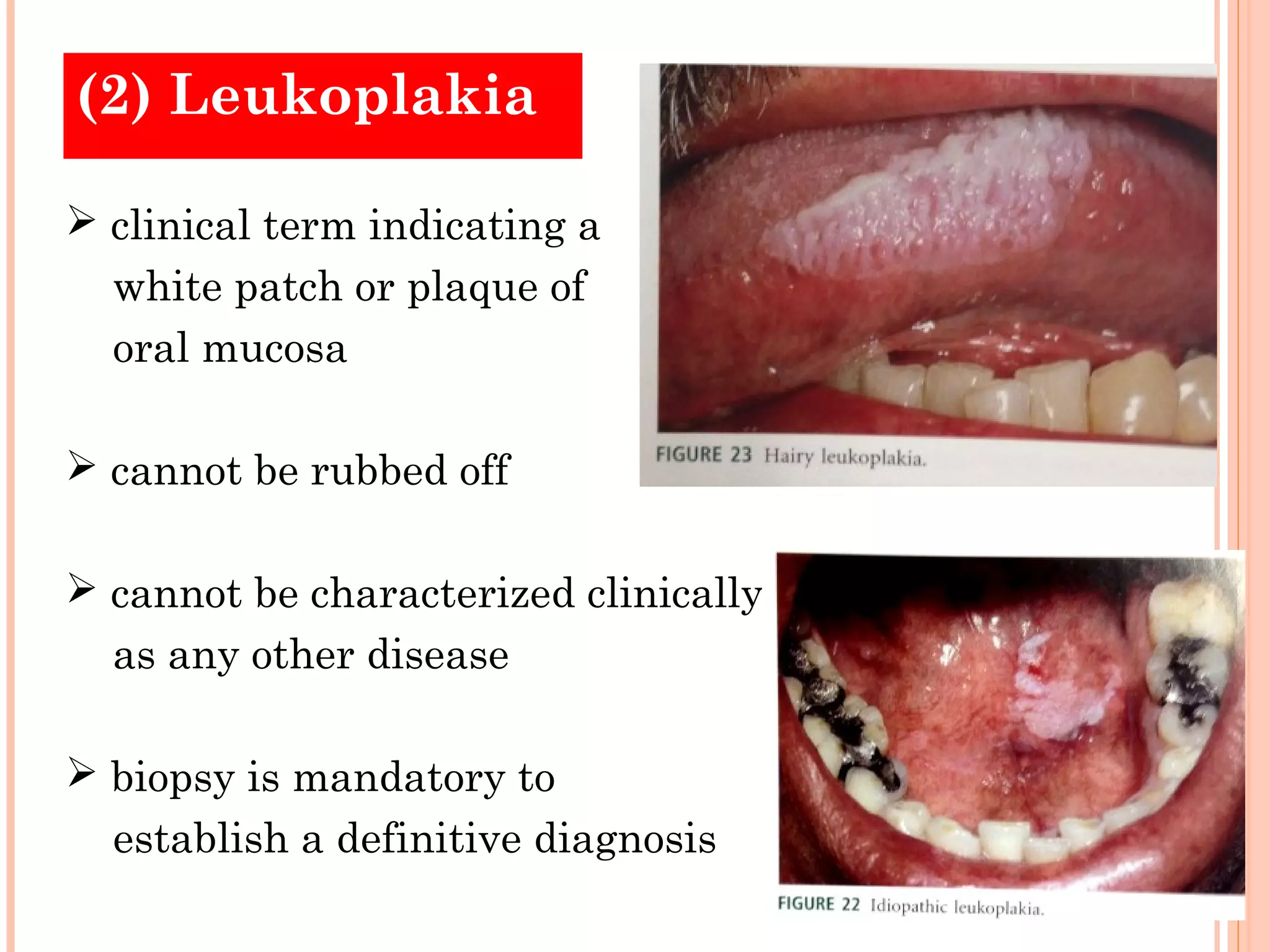White lesions (2) | PPT