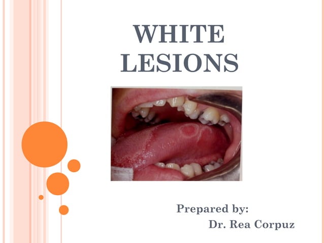 White lesions (2) | PPT | Skin and Dermatology | Diseases and Conditions