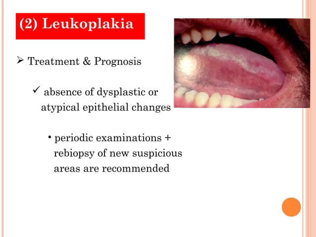 White lesions (2) | PPT | Skin and Dermatology | Diseases and Conditions