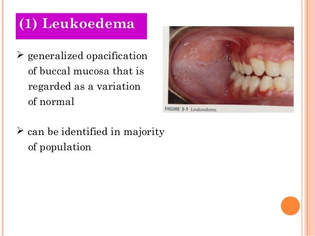 Leukoedema 03 02-06 benign mucosal-lesions_of_the_oral_cavity1