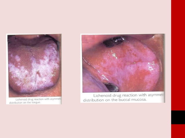 White Lesions of Oral Cavity LICHEN PLANUS.pptx