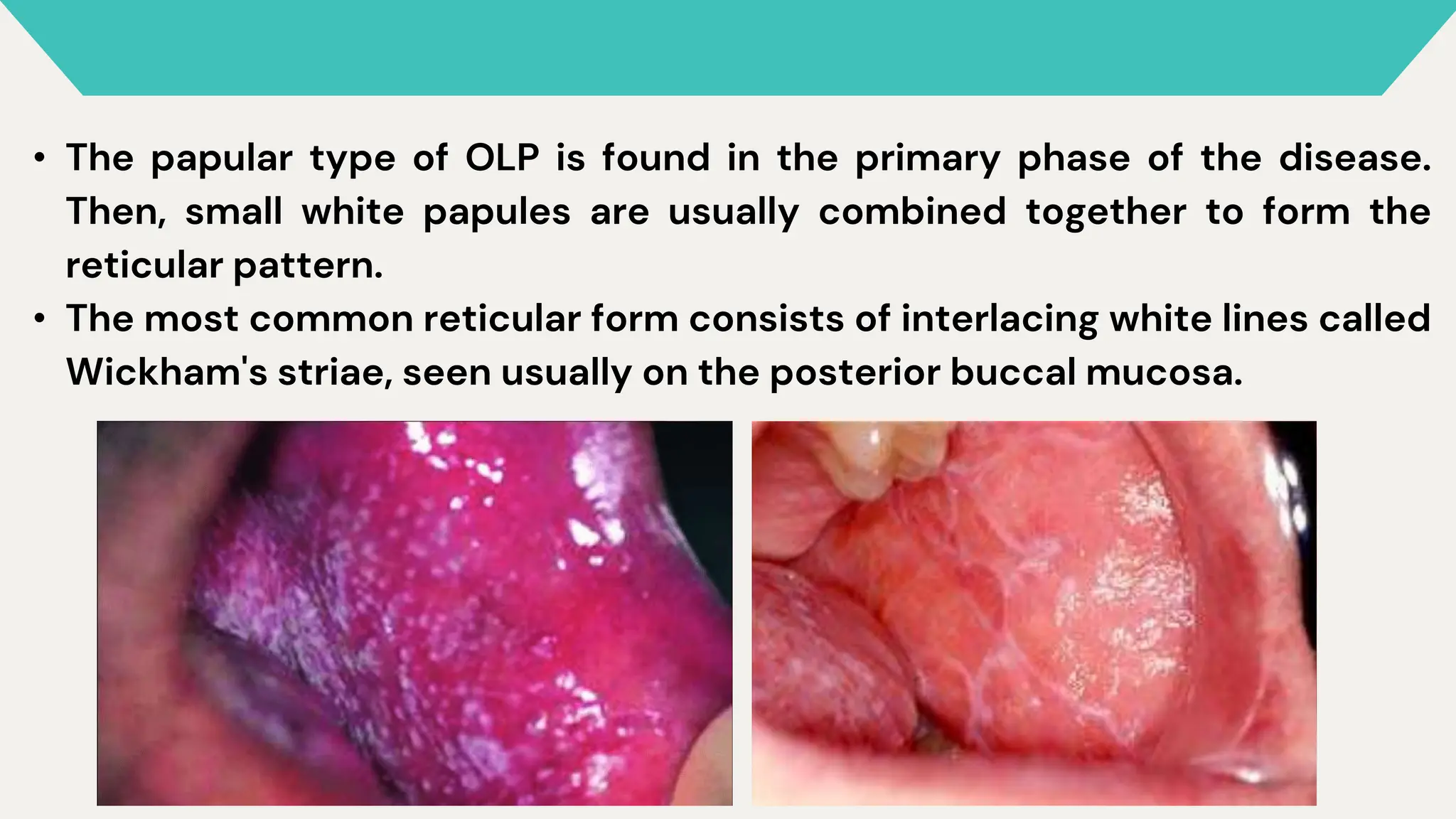 white lesions of oral mucosa........pptx