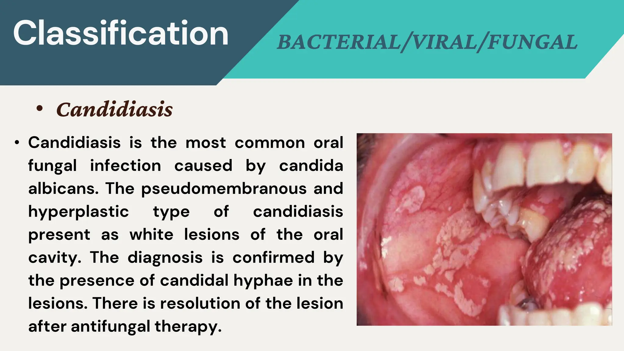 white lesions of oral mucosa........pptx