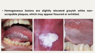 white lesions of oral mucosa........pptx