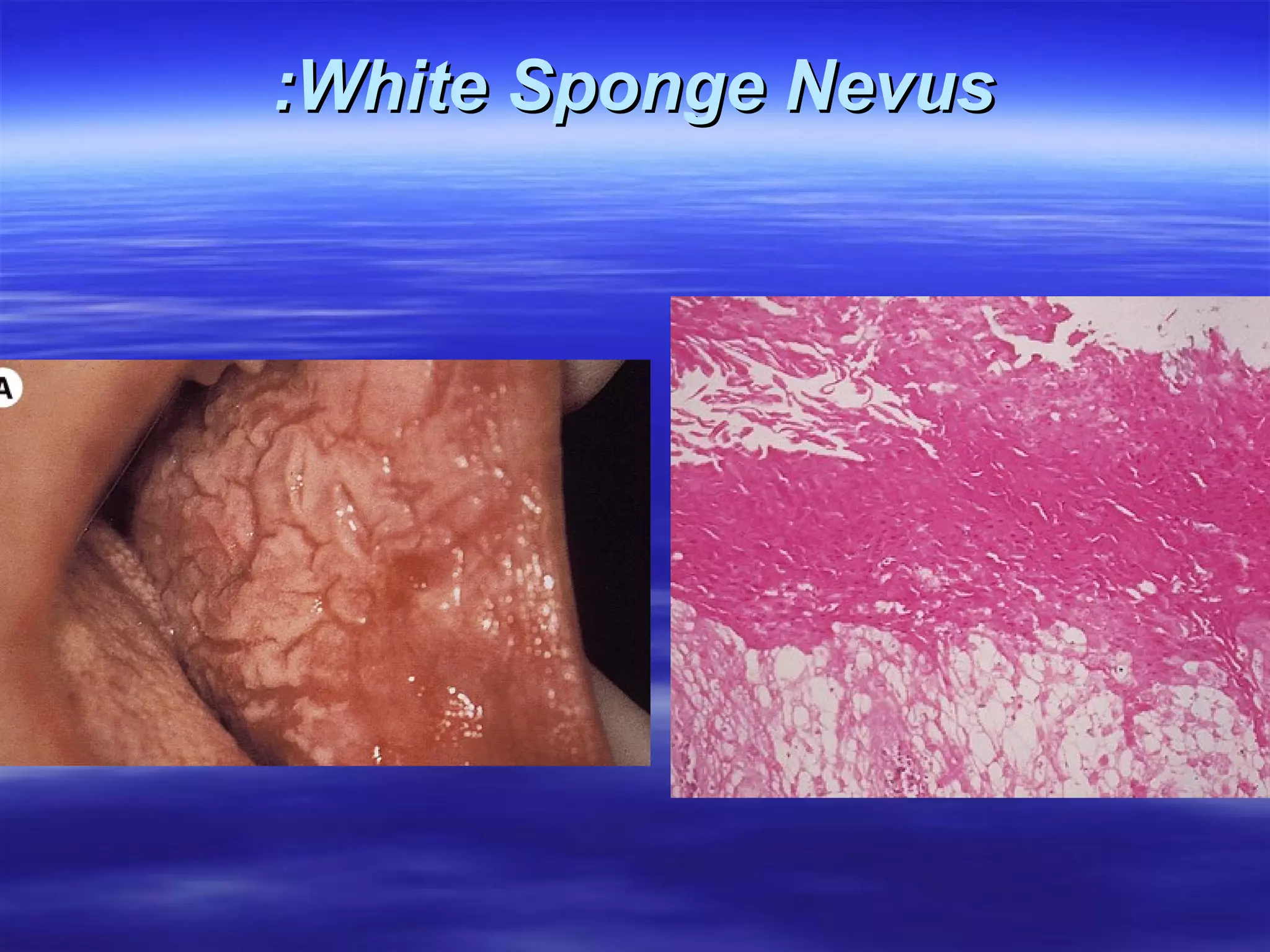 White lesions ppt | PPT