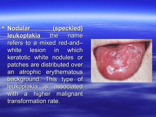 Speckled Leukoplakia