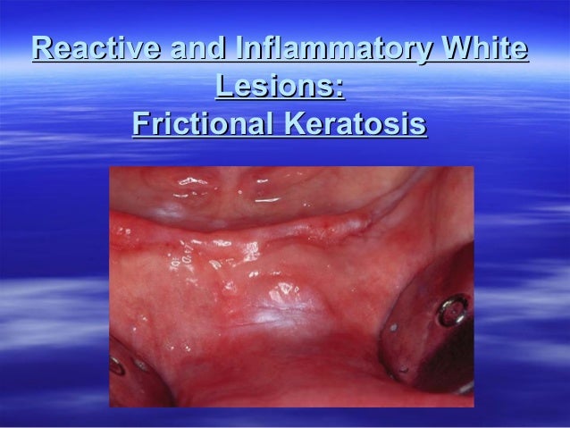 Oral Frictional Hyperkeratosis Tongue