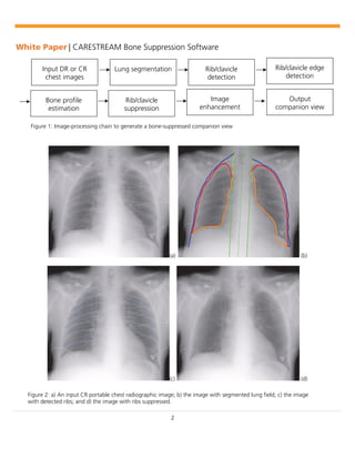 Bone Suppression for Chest Radiographic Images | PDF