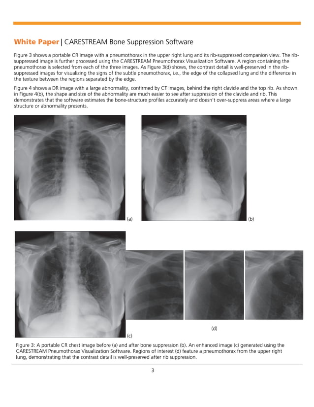 Bone Suppression for Chest Radiographic Images | PDF