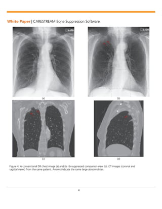 Bone Suppression for Chest Radiographic Images | PDF