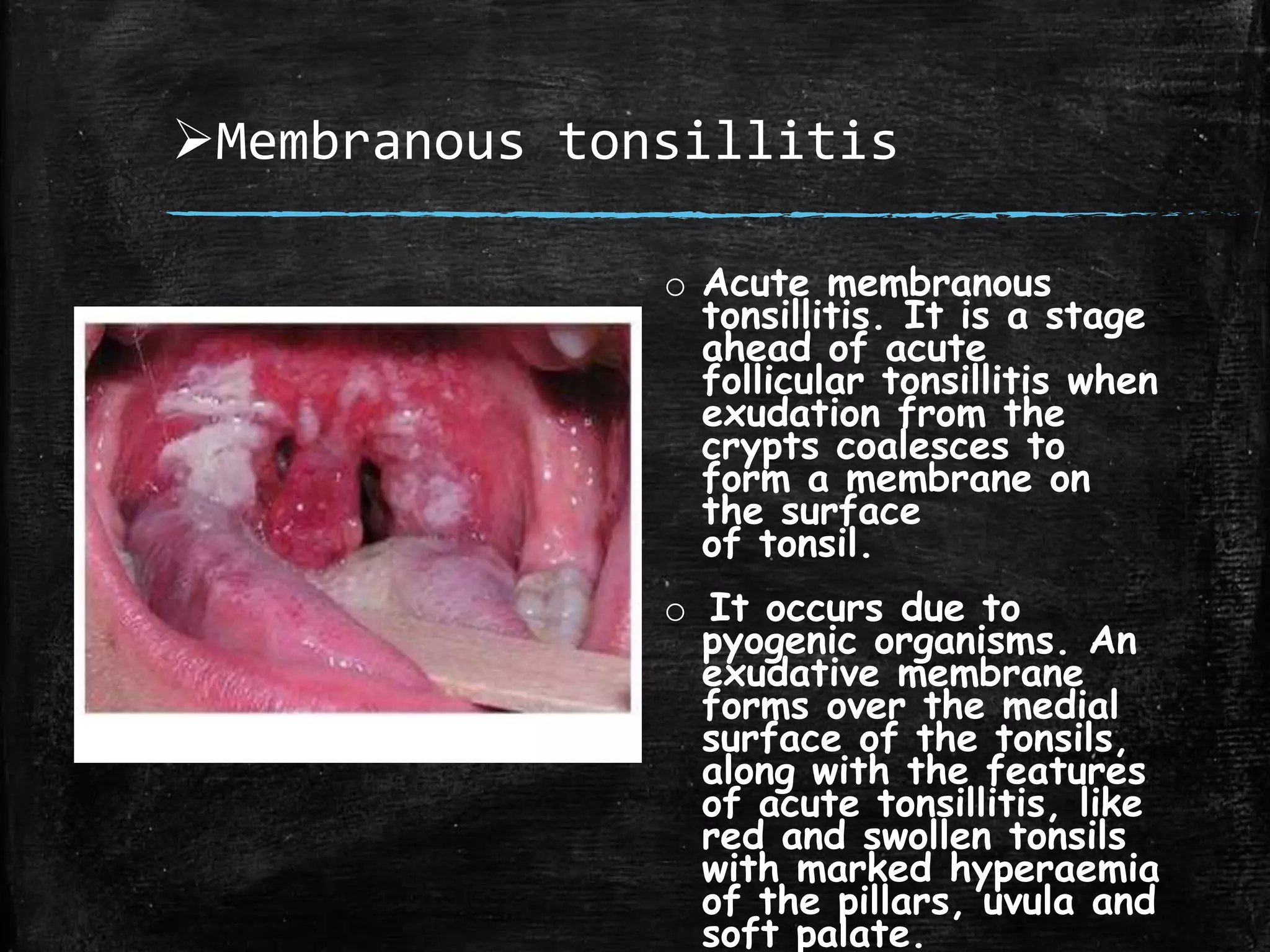 White patch on the tonsil – differential diagnosis | PPTX