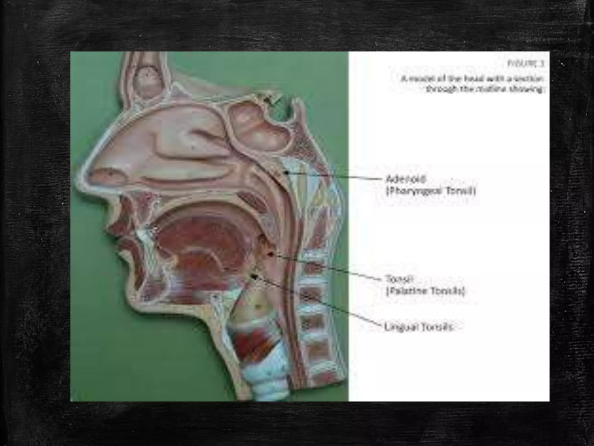 White patch on the tonsil – differential diagnosis | PPTX