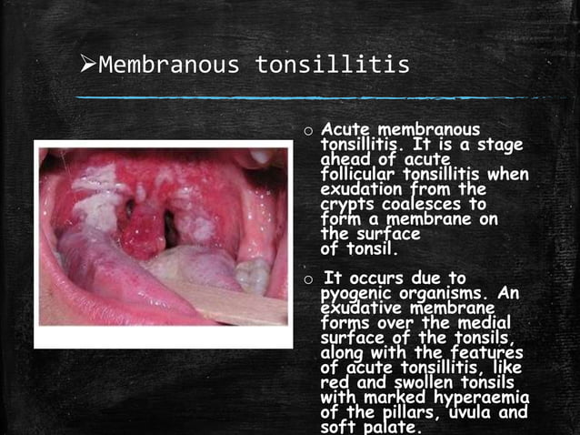 White patch on the tonsil – differential diagnosis | PPTX | Ear, Nose ...