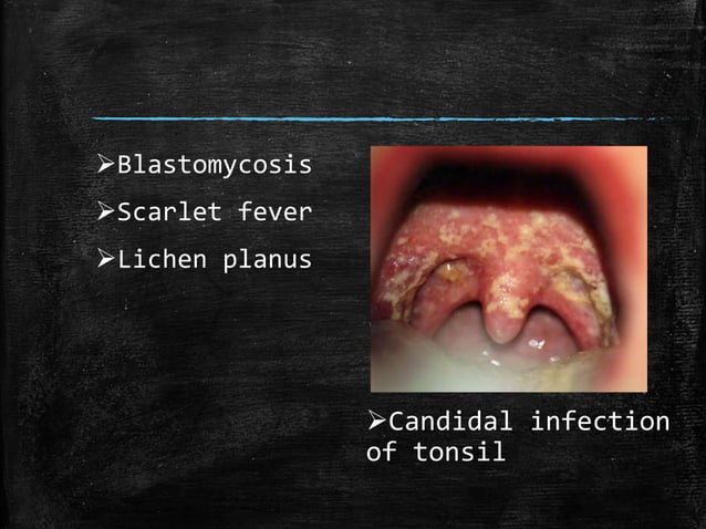 White patch on the tonsil – differential diagnosis | PPTX | Ear, Nose ...