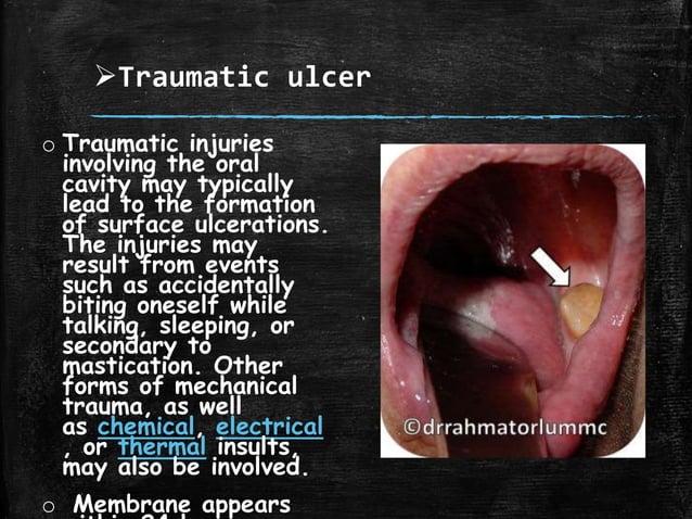 White Patch On The Tonsil Differential Diagnosis