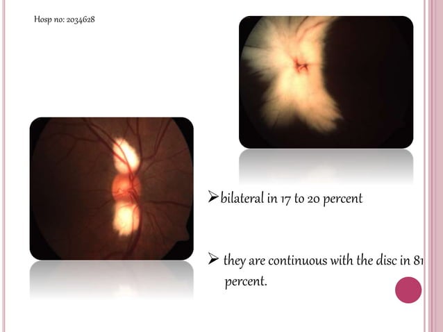 White reflex behind the pupil | PPT