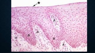 White sponge nevus | PPTX