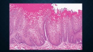White sponge nevus | PPTX