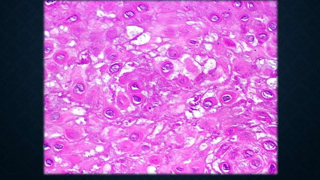 White sponge nevus | PPTX | Skin and Dermatology | Diseases and Conditions