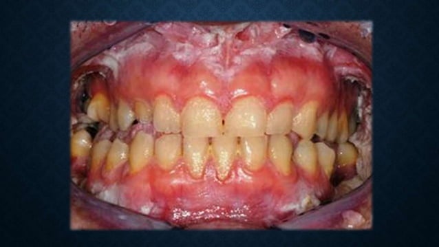 White sponge nevus | PPT