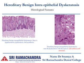 White Spongy Nevus & Hereditary Benign Intraepithelia Dyskeratosis.pdf