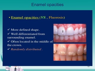 White spot lesion | PPT