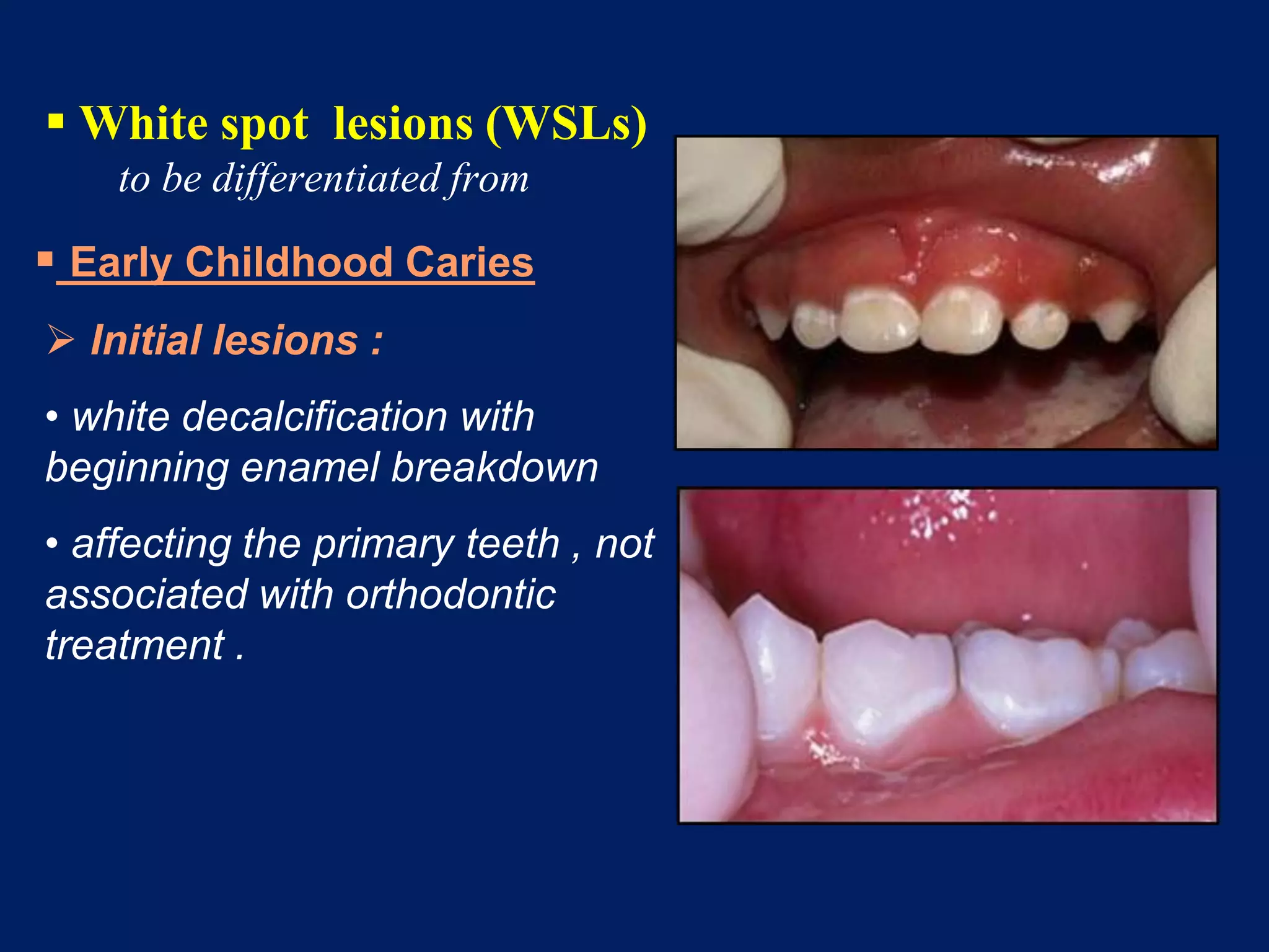 White spot lesions | PPT