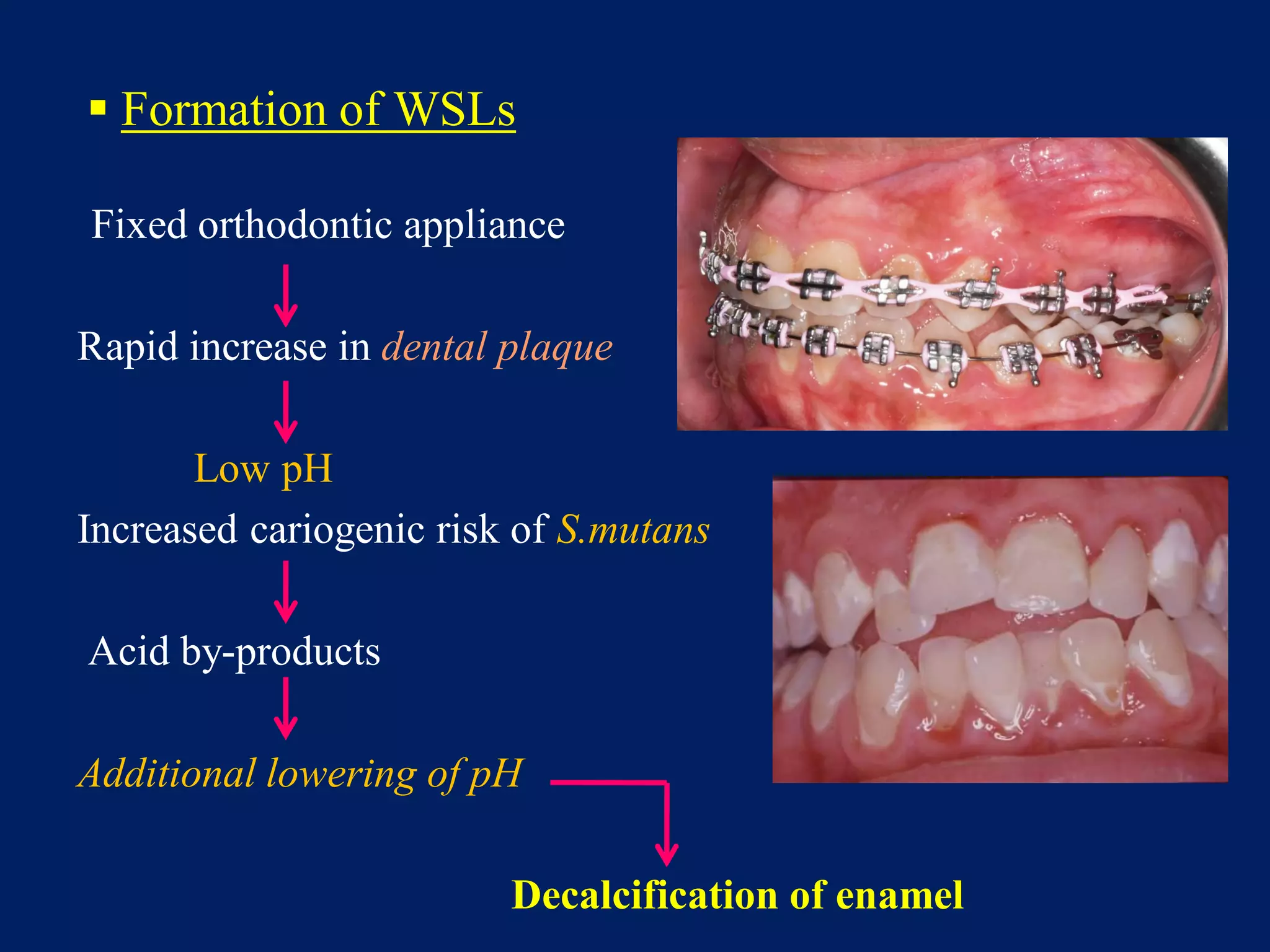 White spot lesions | PDF