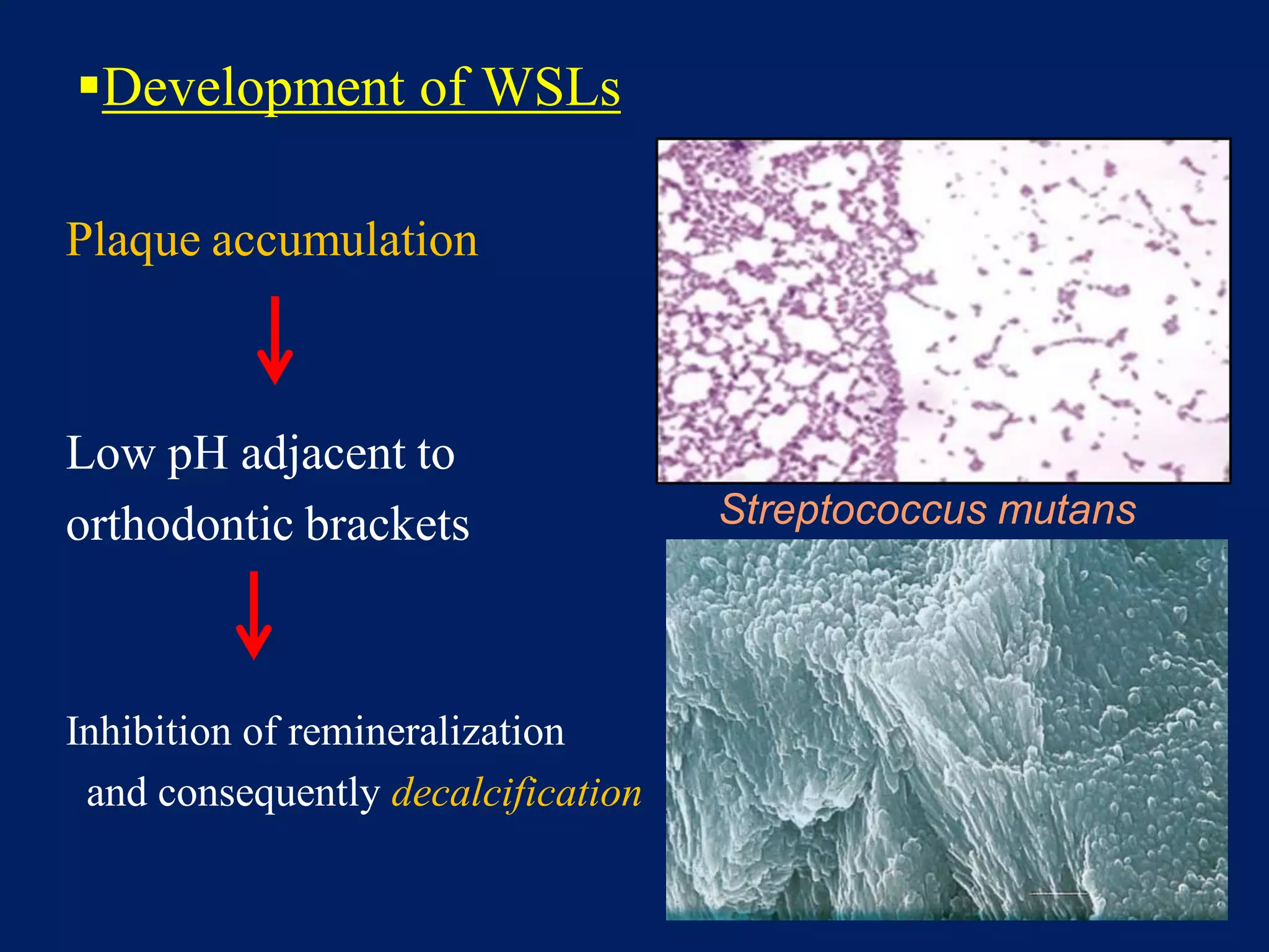 White spot lesions | PDF