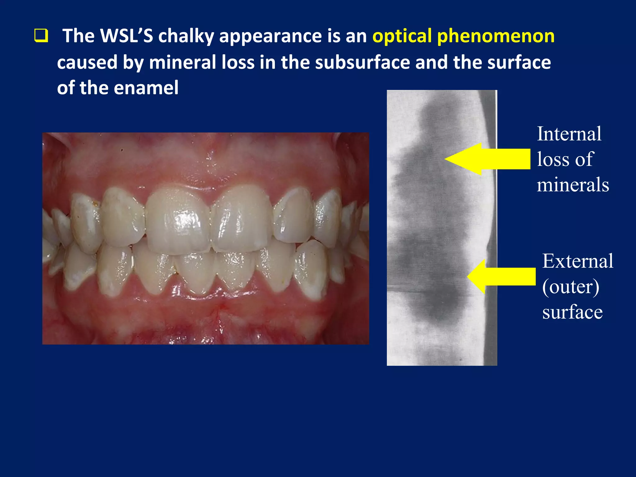 White spot lesions | PDF