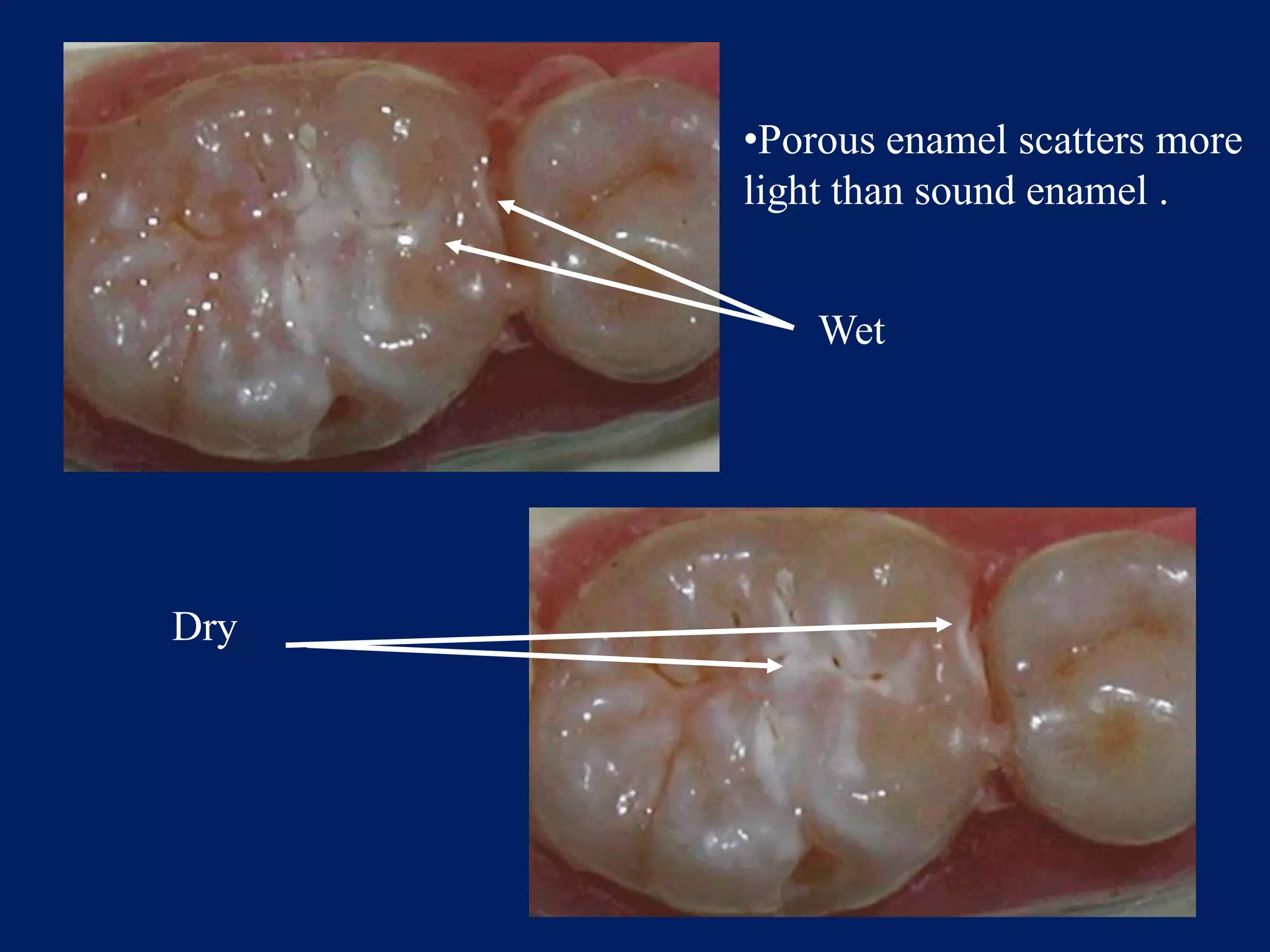 White spot lesions | PDF