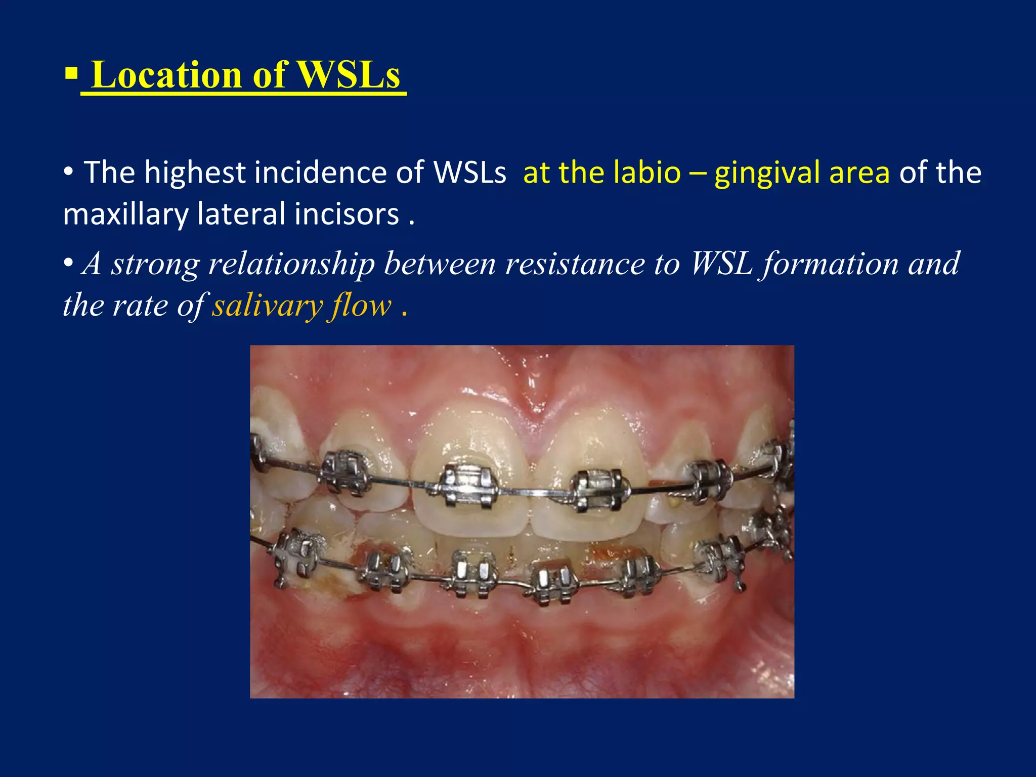 White spot lesions | PDF