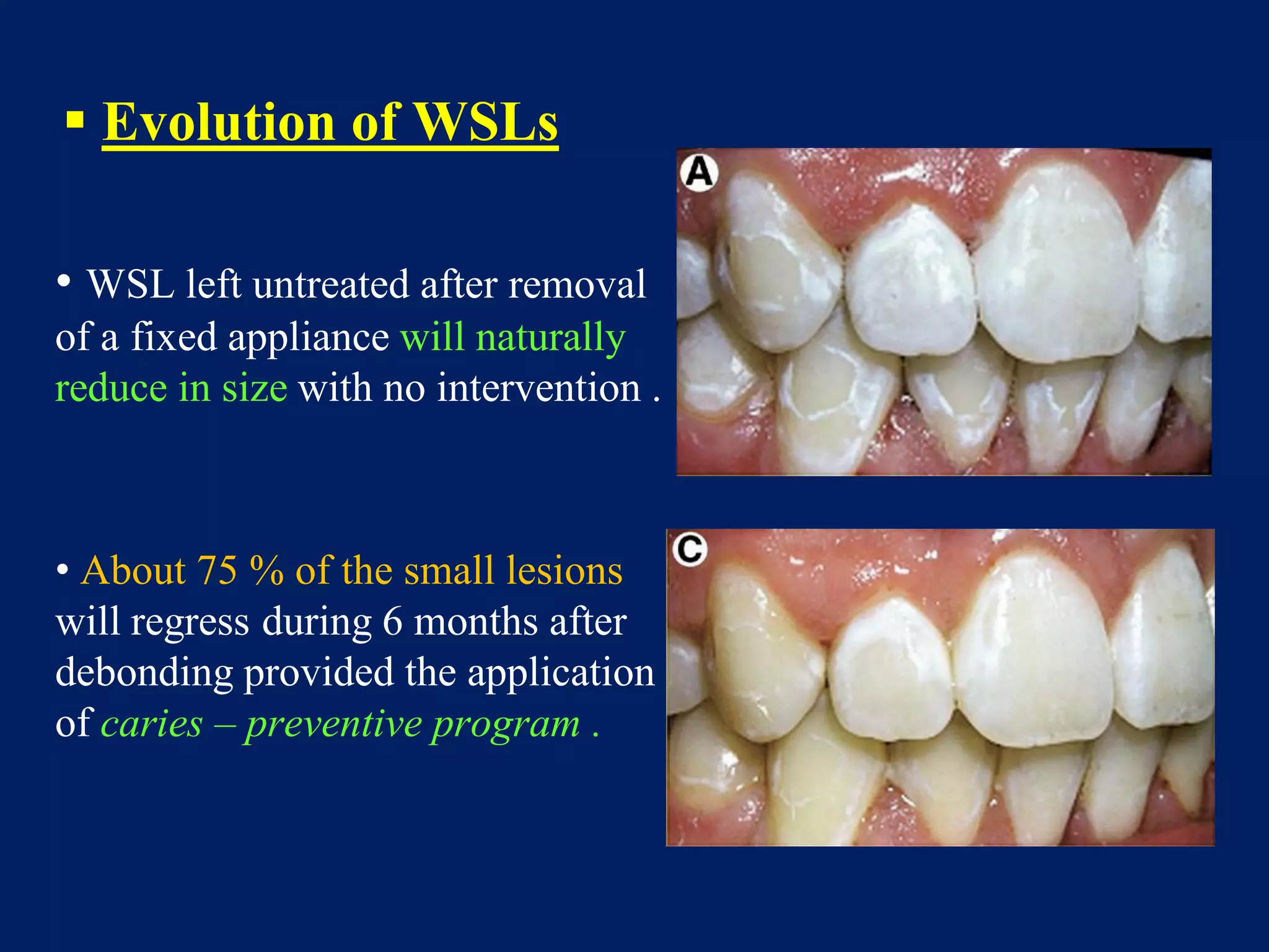 White spot lesions | PDF